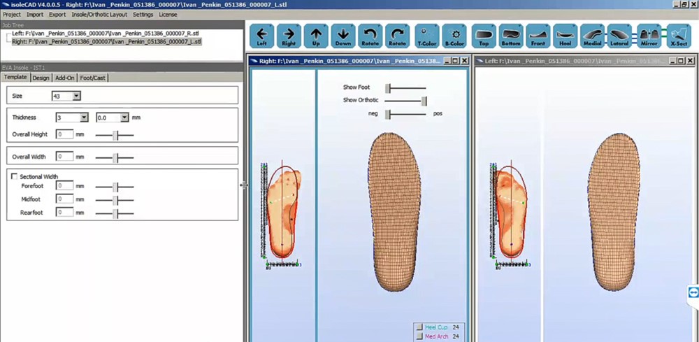 Stages of 3D-Production of Orthopedic Insoles