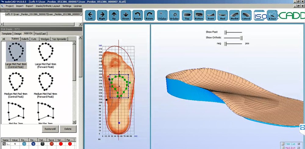 Stages of 3D-Production of Orthopedic Insoles