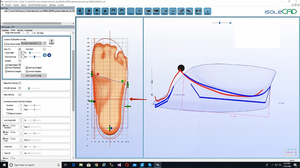 Stages of 3D-Production of Orthopedic Insoles