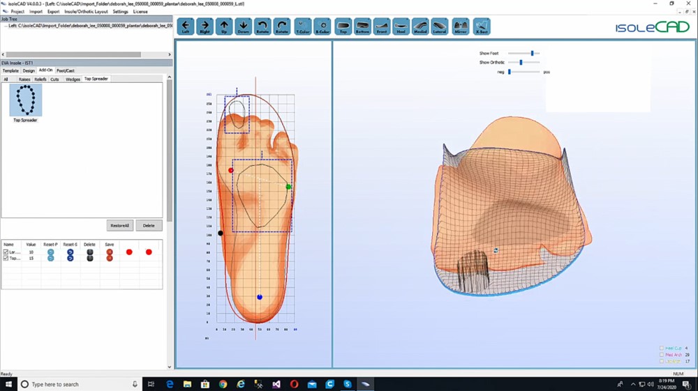Stages of 3D-Production of Orthopedic Insoles