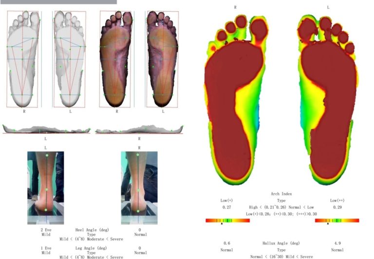 Stages of 3D-Production of Orthopedic Insoles